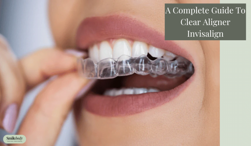 Smilebody's Complete Guide to Clear Aligner Invisalign - Smilebody